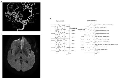 Frontiers Usefulness Of Intraoperative Neurophysiological Monitoring During The Clipping Of