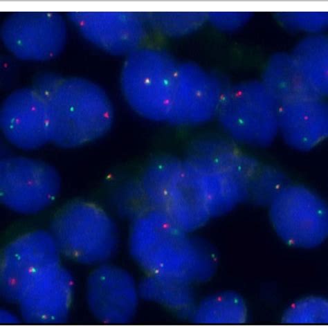 Fluorescence In Situ Hybridization Analysis Is Positive For Myc Gene