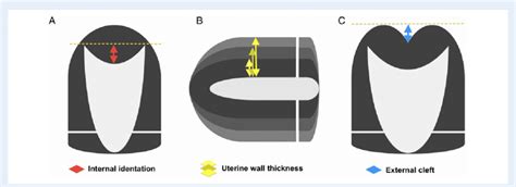 Differentiation Of Normal Septate And Bicorporeal Uterus By The Download Scientific Diagram