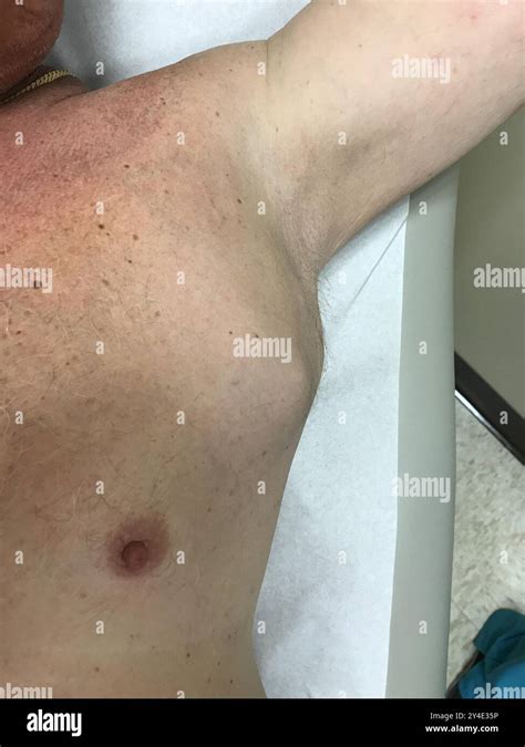 Swollen Lymph Nodes In Armpit