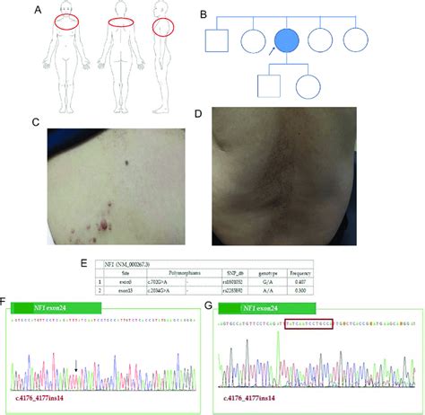 Segmental Neurofibromatosis A The Location Of Lesions In The Patient Download Scientific