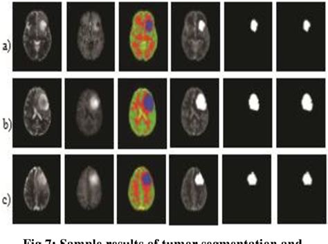Figure 1 From An Automatic Brain Tumor Detection And Segmentation Using Hybrid Method Semantic