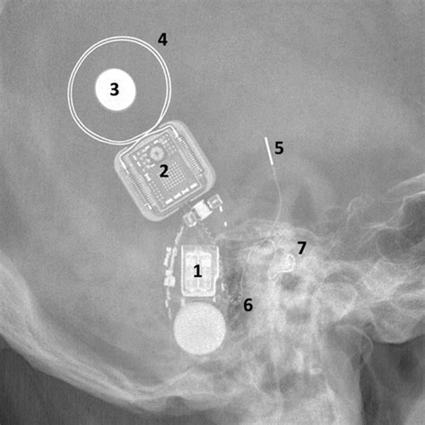 Cochlear Implantation Systematic Approach To Preoperative Radiologic
