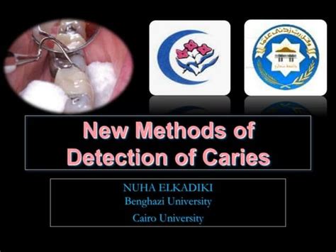 Cracked Tooth Syndrom Pptx