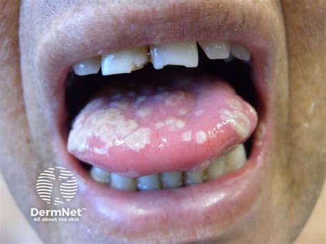 Nicotinic Stomatitis Treatment