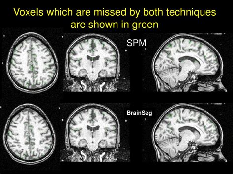 Ppt Segmentation Of Brain Tissues On Mr Images Using Data Driven Techniques Powerpoint
