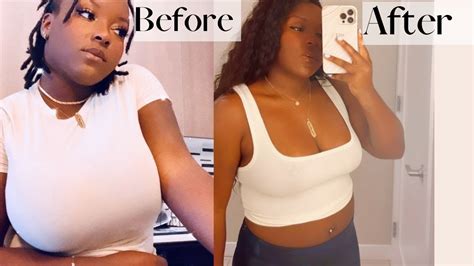 breast reduction before and after ddd