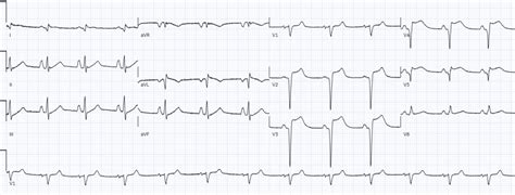 Ecg Cases 41 Stemi Occlusion Mi Complications