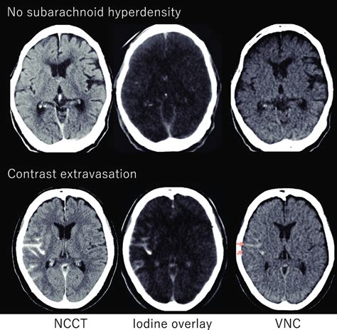 Representative Cases Of Contrast Extravasation On Dual Energy Download Scientific Diagram