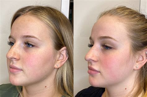 Patient 147538360 Dermal Fillers Before And After Photos Modern Women
