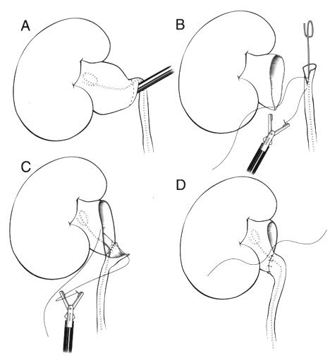Laparoscopic Pyeloplasty Johns Hopkins Medicine