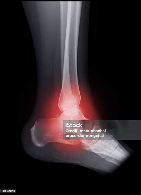 Gambar Rontgen Sendi Pergelangan Kaki Untuk Diagnosis Fraktur Tibia Dan