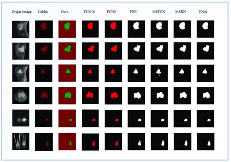 The Effects Of Different Segmentation Models For Osteosarcoma Mri