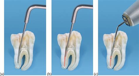 Continuous Wave Compaction Technique Using Elements™ Obturation Unit A