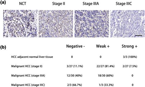 The Expression Level Of P21 Was Decreased With Progression Of Hcc A