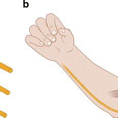 A Schematic Illustration Of A Surgical Nerve Grafting Procedure For A Download Scientific