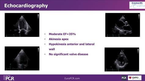 Orbital Atherectomy A Versatile Tool In Managing Complex Scenarios Of Vessel Calcification