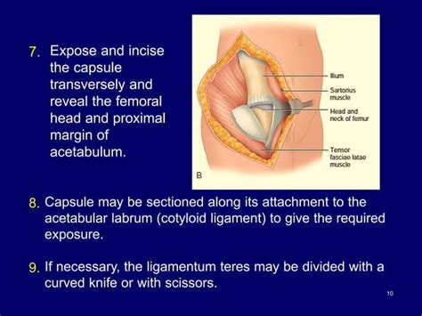Hip Arthroplasty Approach Pdf