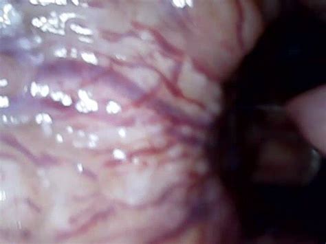 Endoscope Fetish Thisvid Com
