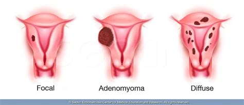 Adenomyosis Symptoms Causes And Treatment Options