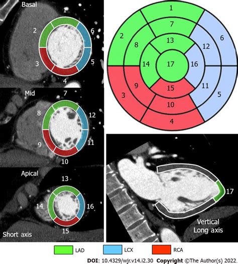 Standard Segmental Myocardial Display In A 17 Segment Model