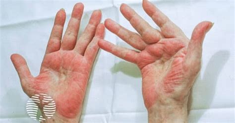 Palmar Erythema Image