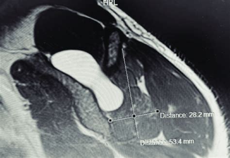 T2 Weighted Image Showing A Spinoglenoid Cyst Over The Supraspinous Download Scientific Diagram