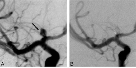 Case 1 Right Internal Carotid Arteriograms Demonstrate A Proximal A1 Download Scientific