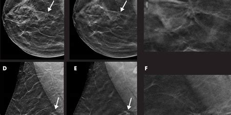 Tomosynthesis With Synthetic Mammography Improves Breast Cancer