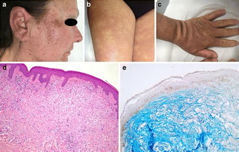 Cutaneous Manifestations Of Scleroderma And Scleroderma Like Disorders
