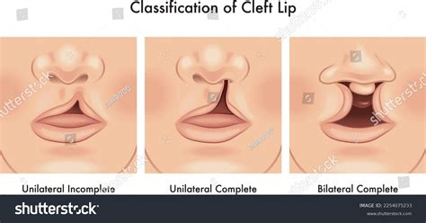 Medical Illustration Shows Classification Cleft Lip เวกเตอร์สต็อก ปลอดค่าลิขสิทธิ์ 2254075233