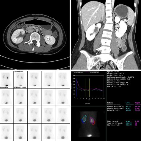 There Were No Specific Findings Other Than Mild Renal Pelvis Dilatation