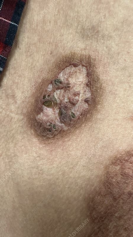 Pyoderma Gangrenosum Treated With Infliximab Stock Image C059 9149