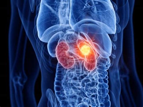 What Are The Symptoms Of Nephrotic Syndrome Udyamoldisgold