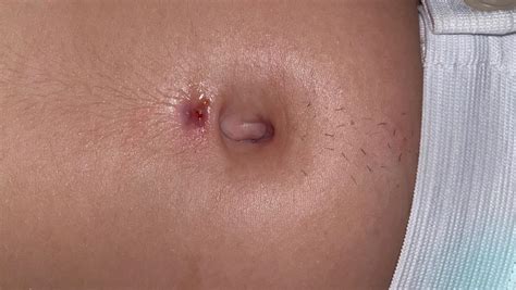 Navel Piercing Infection 3 Ways To Tell If A Piercing Is Infected