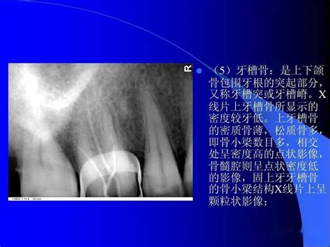 根尖片的正常图像及常见片位的正常图像及应用