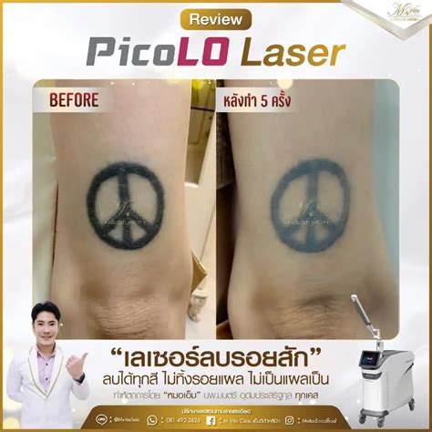 Pico Laser คืออะไร มีกี่แบบ ช่วยอะไรบ้าง ราคาเท่าไร ดีจริงไหม