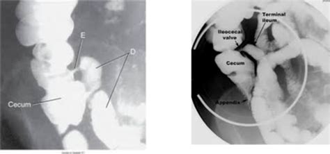 Small Bowel Series Flashcards Quizlet