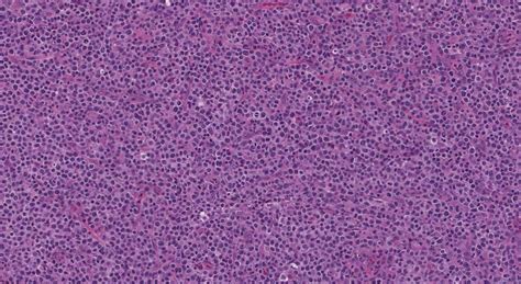 Peripheral T Cell Lymphoma Ottawa Atlas Of Pathology
