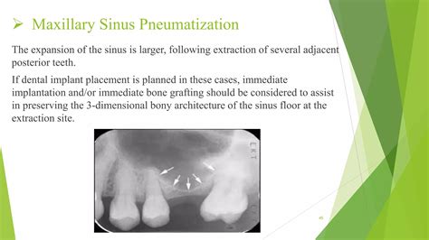 Maxillary Sinus Pptx