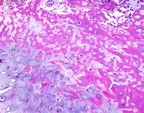 Chondroblastic Osteosarcoma