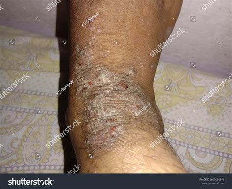 Eczema Bumps On Legs