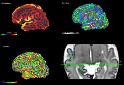 Issues With Dhcp Structural Pipeline Developing Hcp Neurostars
