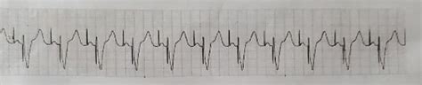 Solved What EKG Reading Is This Graph Chegg Com