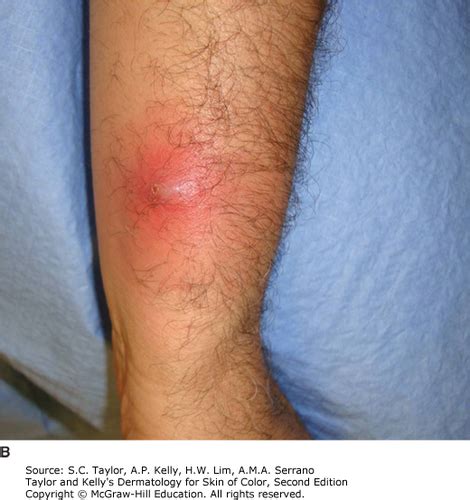 Skin Abscess Flashcards Quizlet