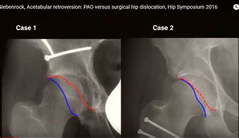 Acetabular Retroversion Pao Versus Surgical Hip Dislocation —