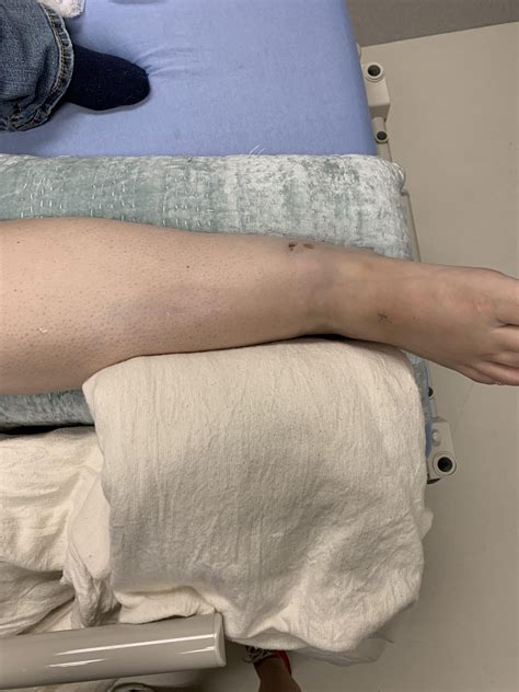 Tri Malleolar Right Ankle Fracture Orif Rmedicalgore