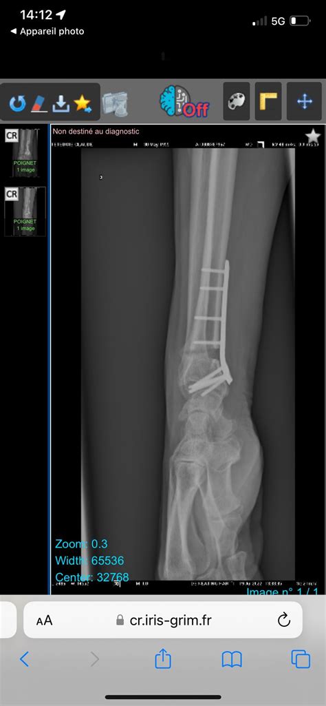 Psi Radius Osteotomy Wonderful Very Good Outcomes 3 Months Later Au
