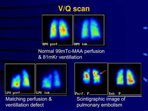 Ppt Comprehensive Guide To V Q Scintigraphy In Pulmonary Imaging Powerpoint Presentation Id