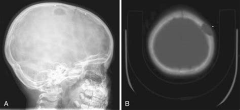 Skull Tumors And Fibrous Dysplasia Neupsy Key